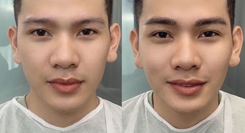 Spa môi mày - THẨM MỸ NAM WINSTON HẢI PHÒNG